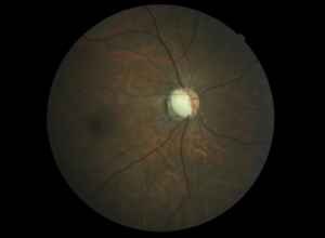 Glaucoma Treatment - Glaucoma Causes - Clinics in Auckland